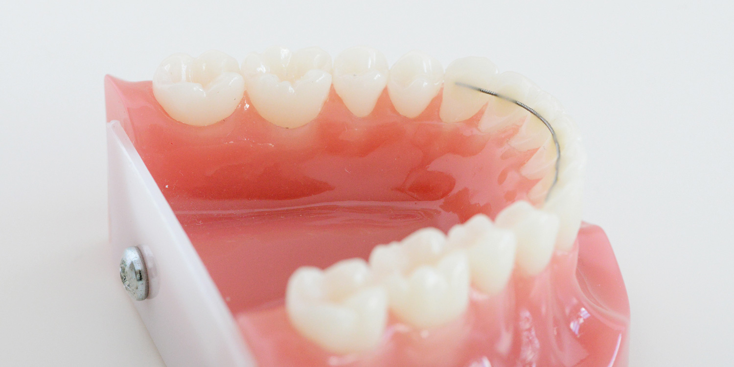 Retainer - KFO Steiniger